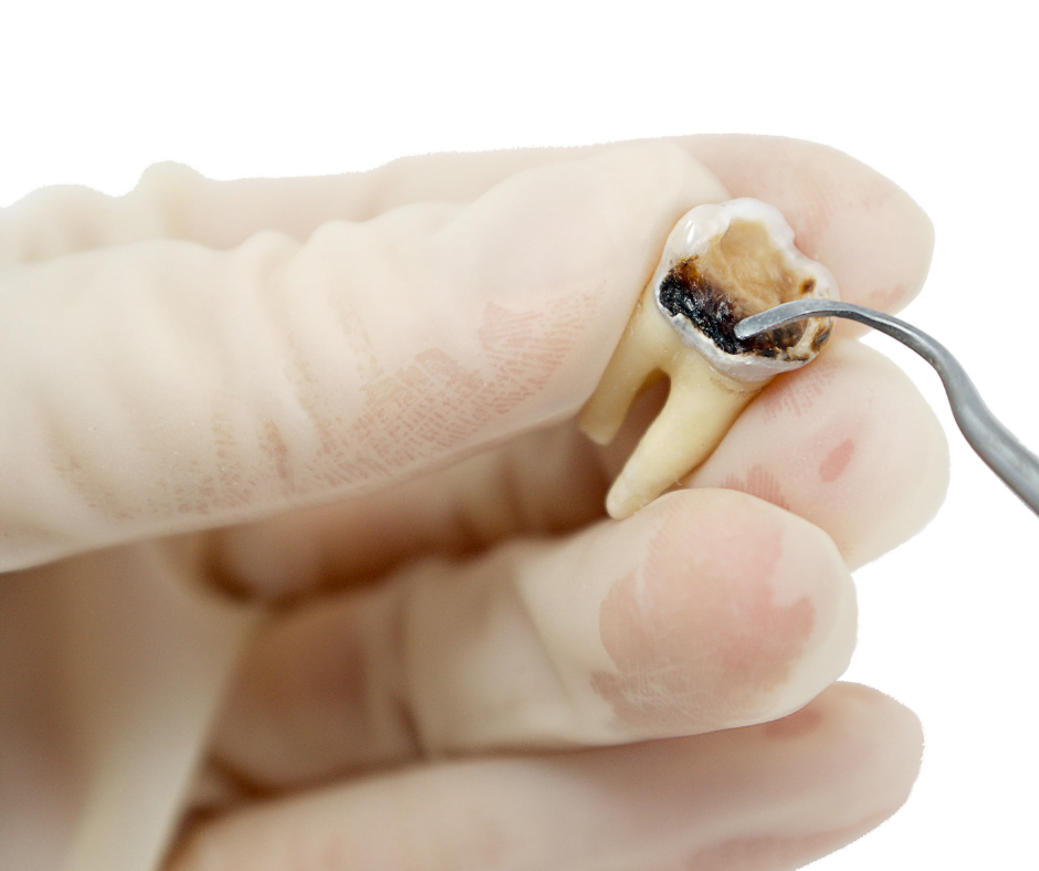 How to Get Rid of Cavities - Tavistock Family Dentistry